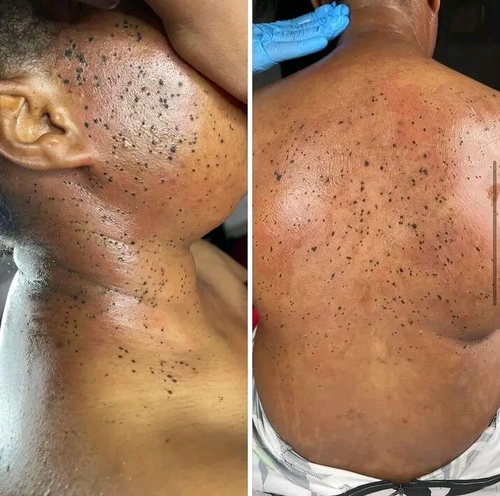 Understanding Skin Tags: Why They Develop and How to Remove Them ...