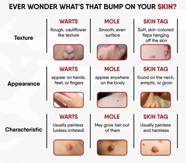Understanding Skin Tags: Why They Develop and How to Remove Them ...